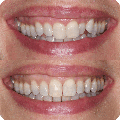 Functional Orthodontics: Optimal Jaw Development
